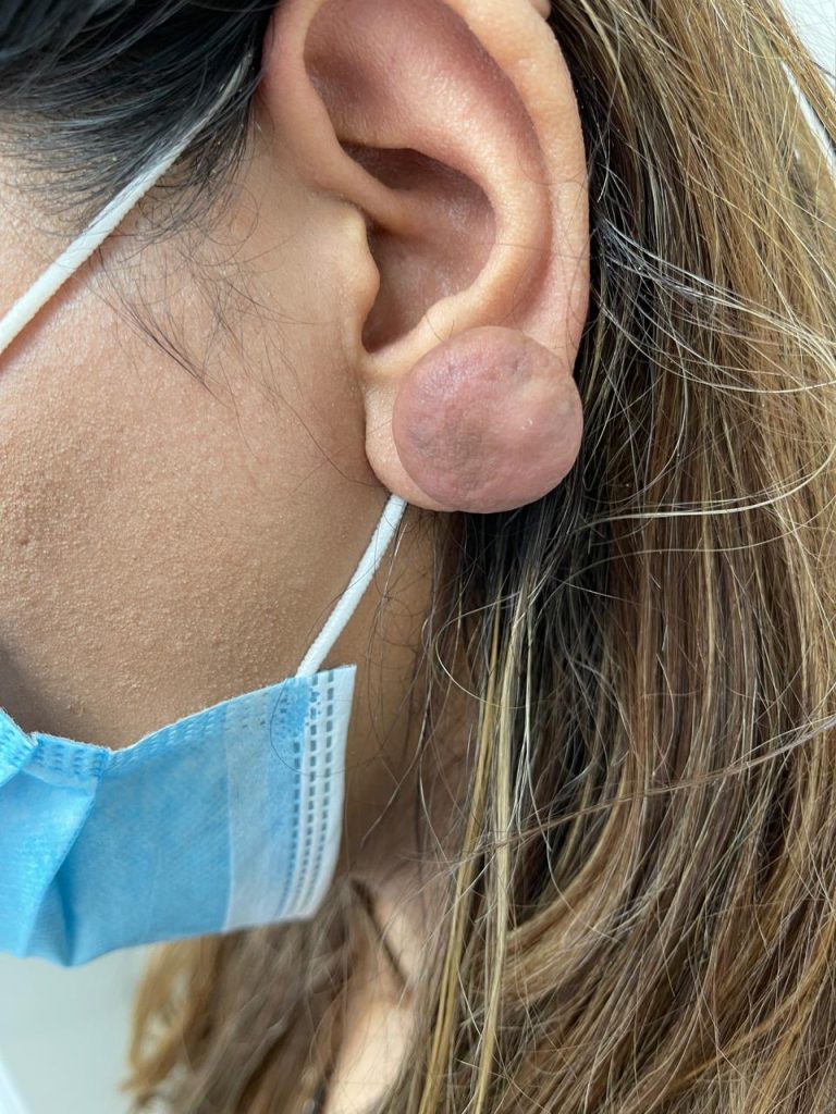 Keloid Treatments – Skin Medics