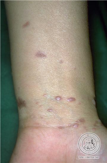 Lichen Planus – Skin Medics