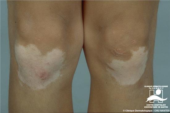 Vitiligo – Skin Medics